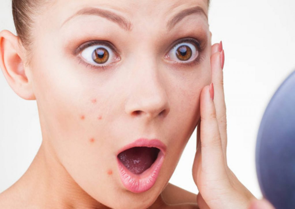 15 Top Natural Remedies For Pimples To Get Rid Of Pimples Overnight 