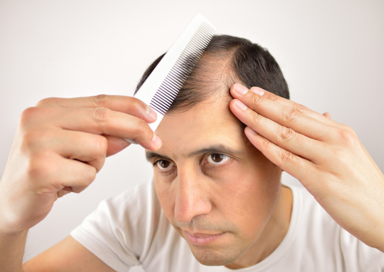 What Are The First Signs Of Balding and How It Can Be Cured? - Baggout